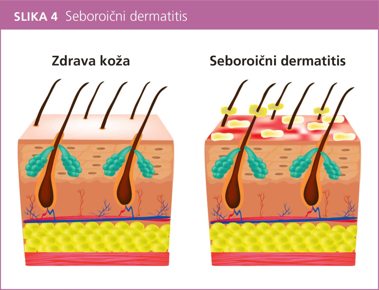 Vrste dermatitisa i pomoć iz ljekarne - inPharma