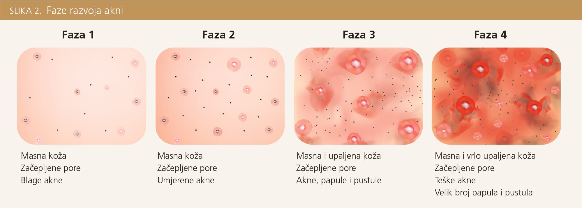 Akne – terapijske i dermokozmetičke mogućnosti - inPharma
